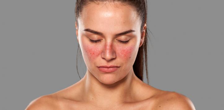 12 Subtle Lupus Symptoms That Are Easy To Miss - Geelong Medical ...